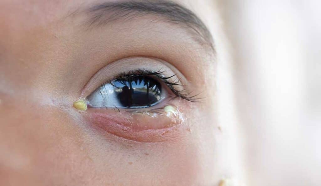 Conjonctivite Bébé: Symptômes Et Traitement Rapide