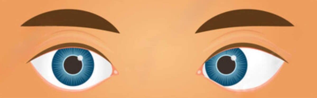 Strabisme : Comprendre, Diagnostiquer Et Traiter