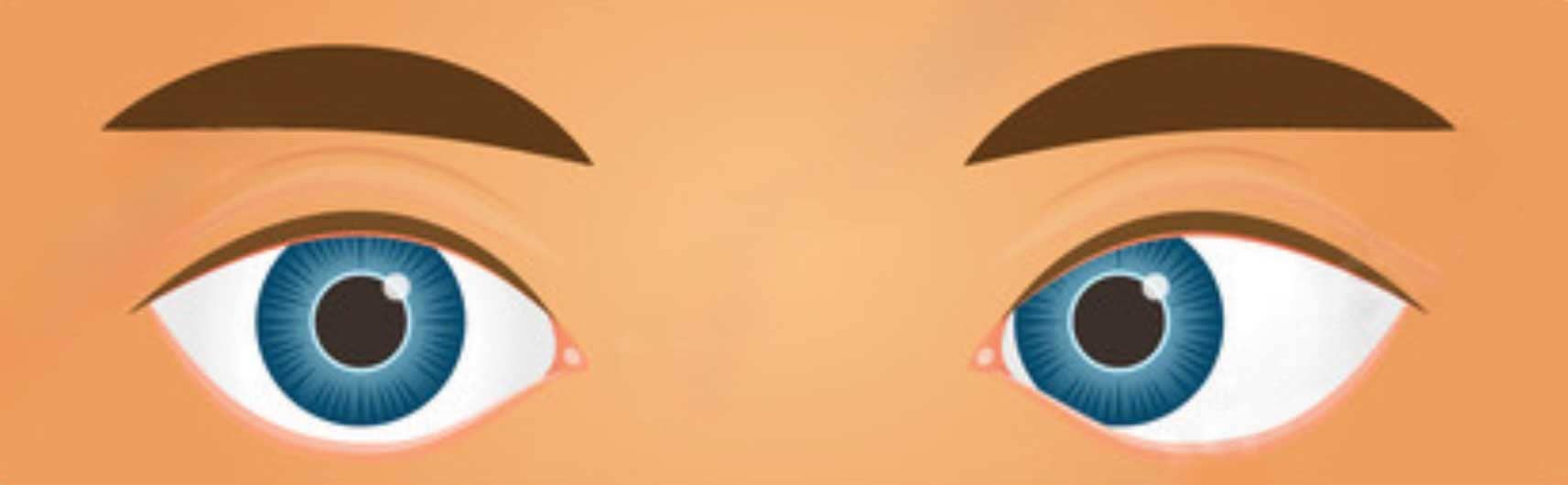 Strabisme : Comprendre, Diagnostiquer Et Traiter