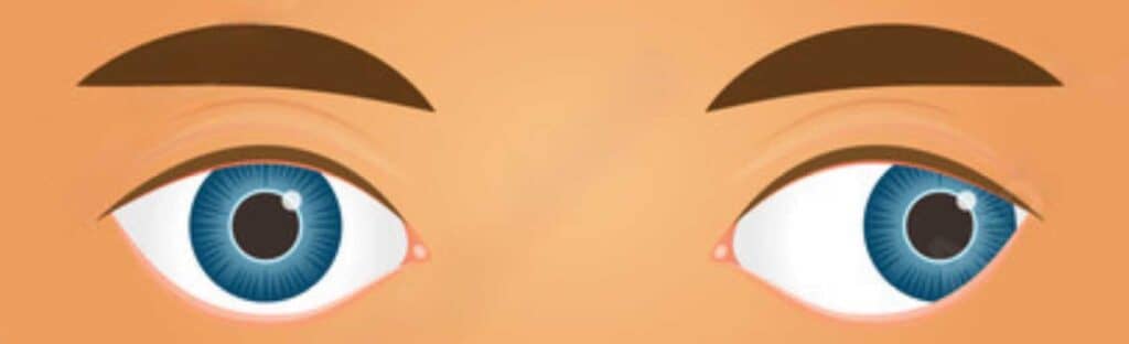 Strabisme : Comprendre, Diagnostiquer Et Traiter