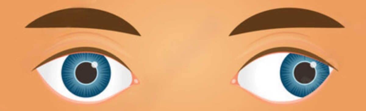 Strabisme : Comprendre, Diagnostiquer Et Traiter